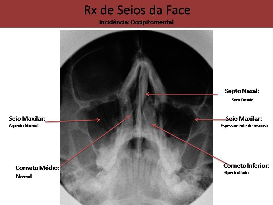 RX :: Otorrino UFPB